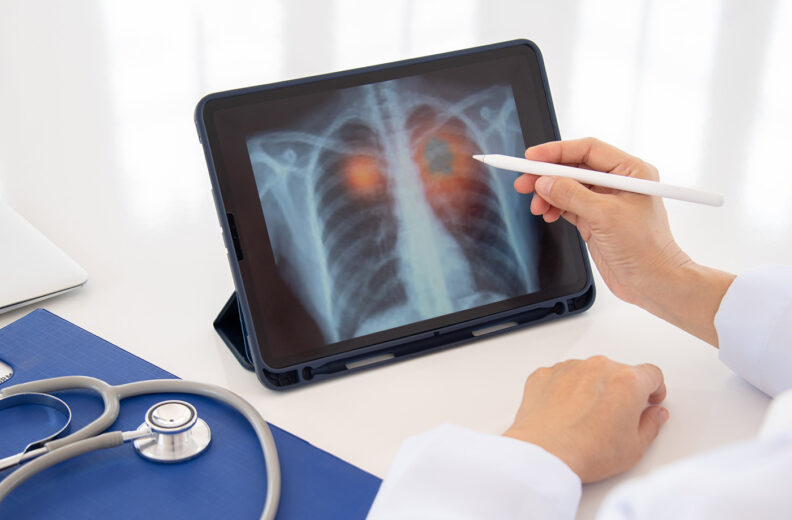 Study on the Impact of Rurality in Lung Cancer Screening Access ...