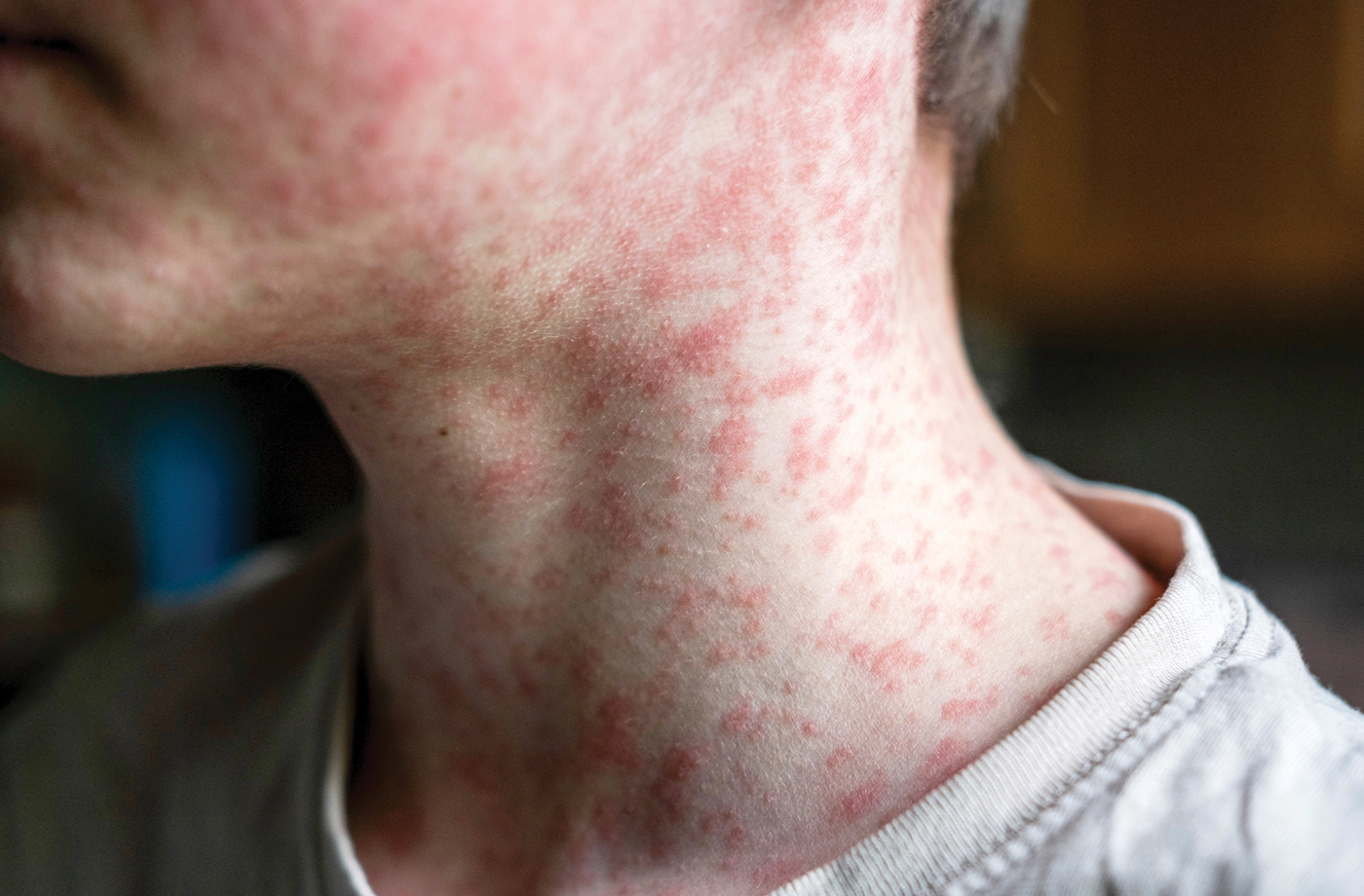 Alison Haddock Talks Measles Precautions on NBC | Elson S. Floyd ...